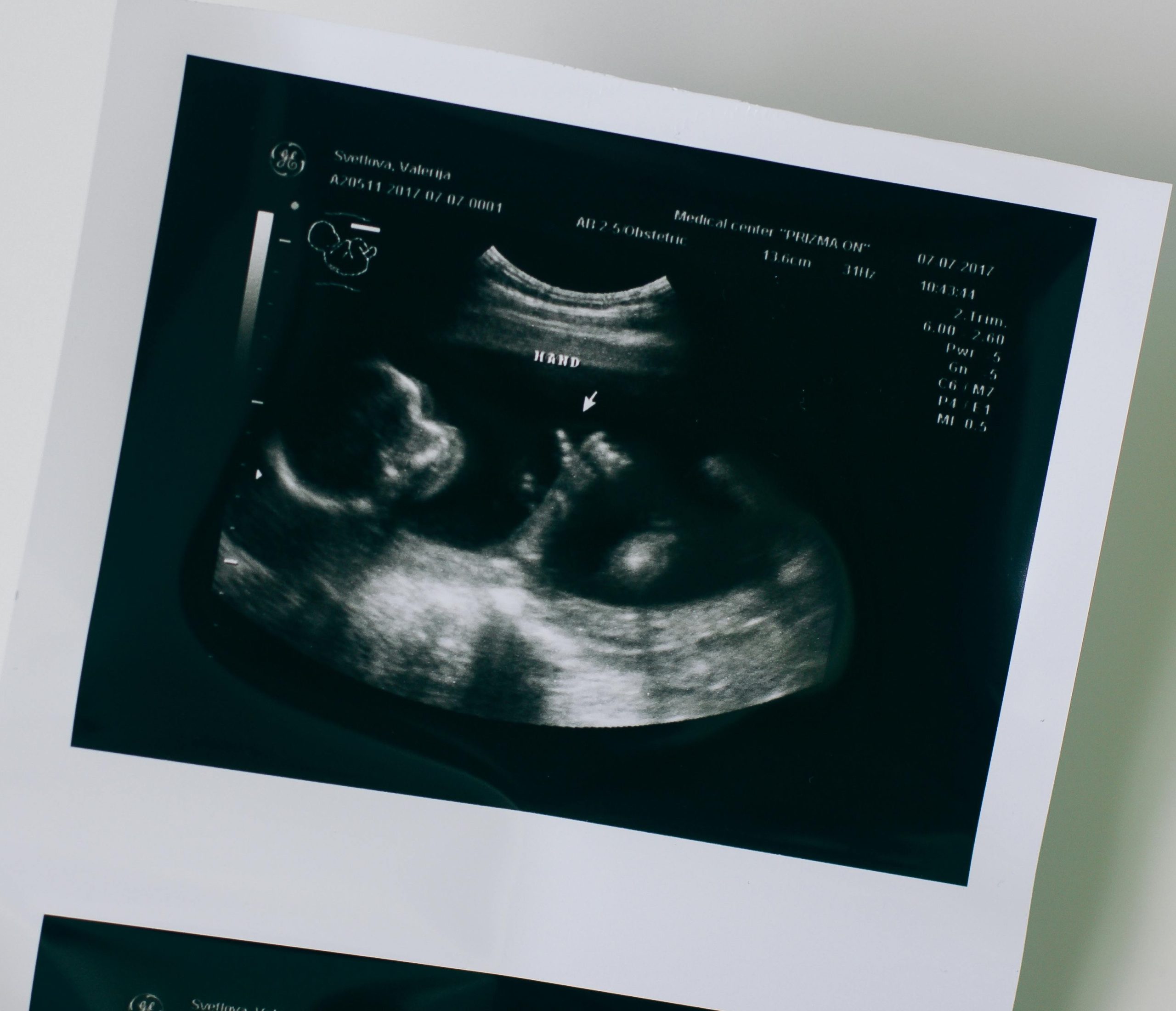 What is a frozen embryo worth? Alabama’s IVF case reflects bigger ...